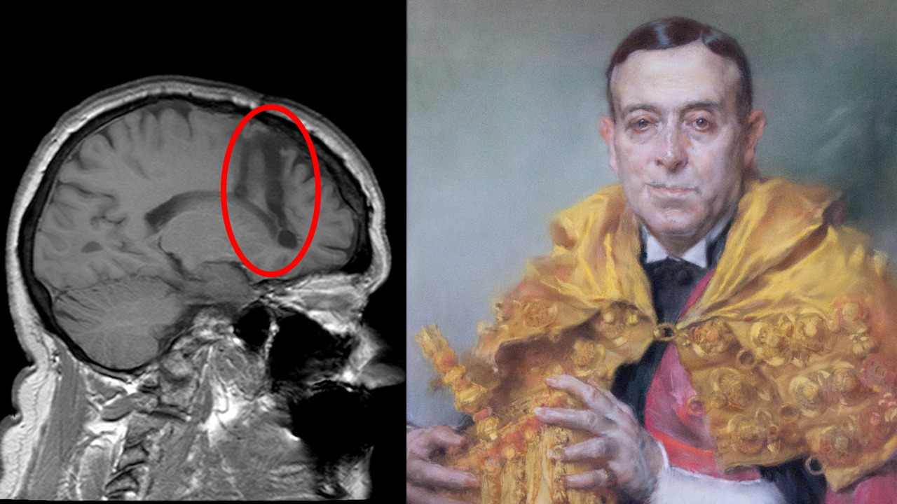 Historia lobotomii i Antonio Egas Moniz. To przez niego dziesiątkom ...